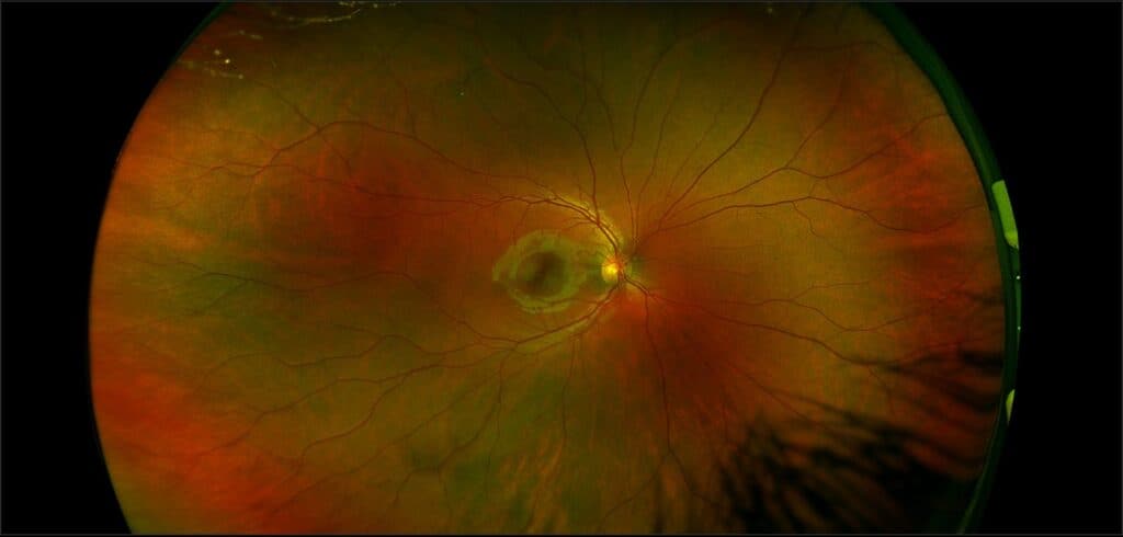 OptoMap – Compton Eye Associates